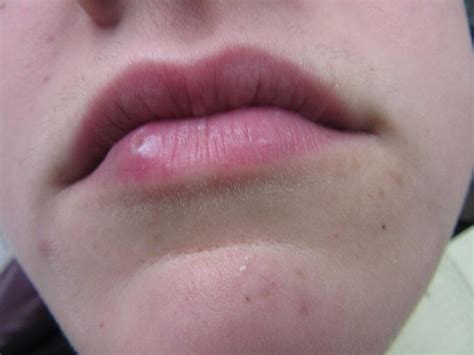 A Lesion Of The Lower Right Lip Is Evident Download Scientific Diagram