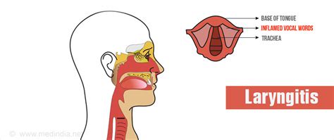Laryngitis Causes Symptoms Diagnosis Treatment