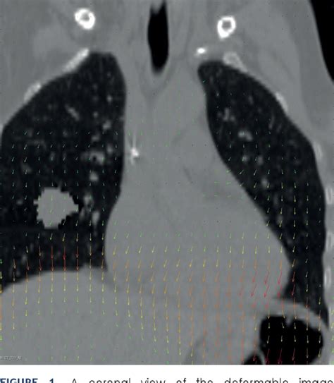 Figure 1 From The Dose Accumulation And The Impact Of Deformable Image Registration On Dose