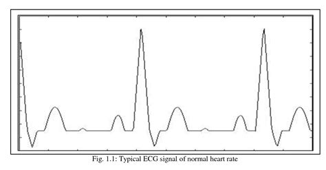 Figure 11 From Ecg Signal Analysis For Abnormality Detection In The Heart Beat Semantic Scholar