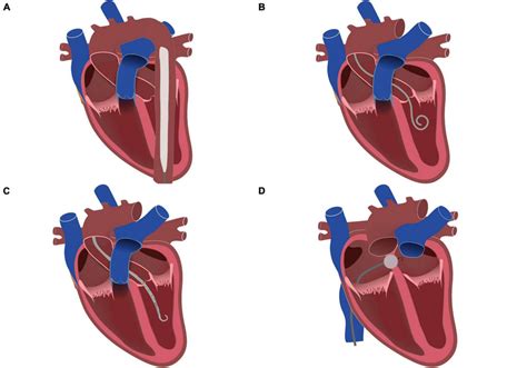 Left Ventricular Unloading Methods During Va Ecmo Treatment A Download Scientific Diagram