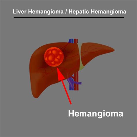 Dattaprasanna Kulkarni On Linkedin Liver Hemangioma Hepatic Hemangioma