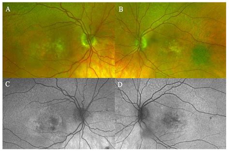 Case 5 Multimodal Imaging Features Of Bacillary Layer Detachment