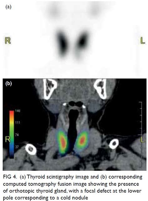 Abdominal Para Aortic Ectopic Thyroid Tissue Mimicking Lymphadenopathy