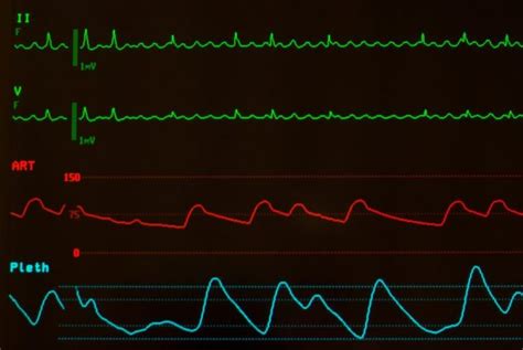 The Types Of Tachycardia Health Detox Vitamins