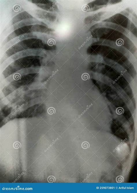 Chest X Rays Show Advanced Pulmonary Tuberculosis Royalty Free Stock Photography