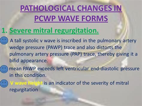 Cvp And Pcwp Monitoring Dr Randeep Singh Dhaliwal Moderated By Dr Harsh Madhok Ppt Video