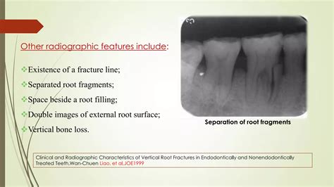 Vertical Root Fracture Pdf