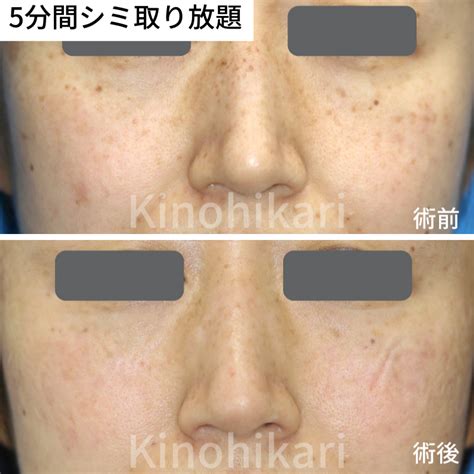 5分間シミ取り放題シミがやたらと気になるようになってきた 40代女性症例No 29Y000000591 樹のひかり形成外科皮ふ科