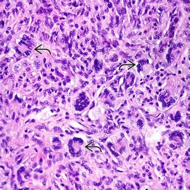 Xanthogranuloma Pictures Photos