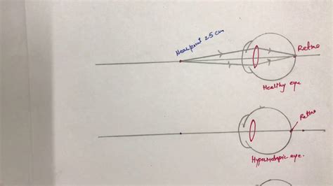 Hypermetropia Diagram Hypermetropia Ray Diagram Hypermetropia And