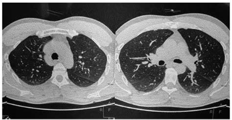 Ramr Volume 23 Number 3 Exacerbated Bronchial Asthma And Hypersensitivity Pneumonitis