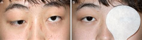 A The Patient Case 9 Showed Ptosis And Hypotropia In The Right Eye