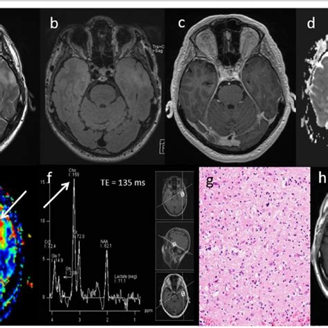 High Grade Glioma Conventional Mri A B Axial And Coronal