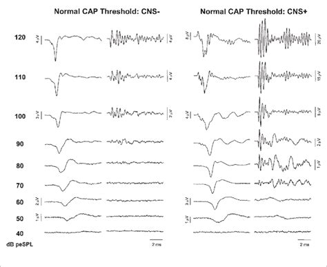 Electrocochleography Recordings From Two Representative Download