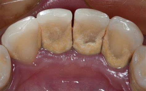 Bacterial Plaque Find Out What It Is And How You Can Fight It🦷 — Prodent