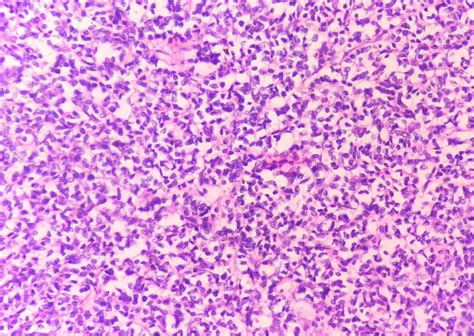 Clusters Of Polygonal Cells With Scant Cytoplasm Separated By Thin