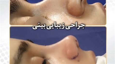 عمل بینی نیمه فانتزی