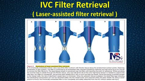 Ivc Filter Pdf