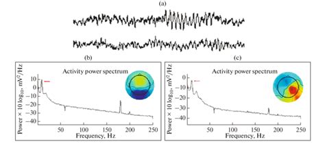 Time Series A And High Variance B And Low Variance C Neurogenic