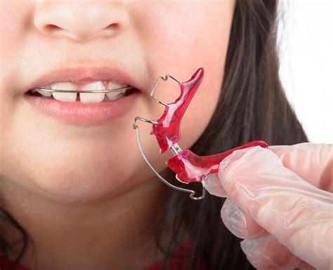 Retainers After Braces Essential Tips For Lasting Results Favourite Dentistry
