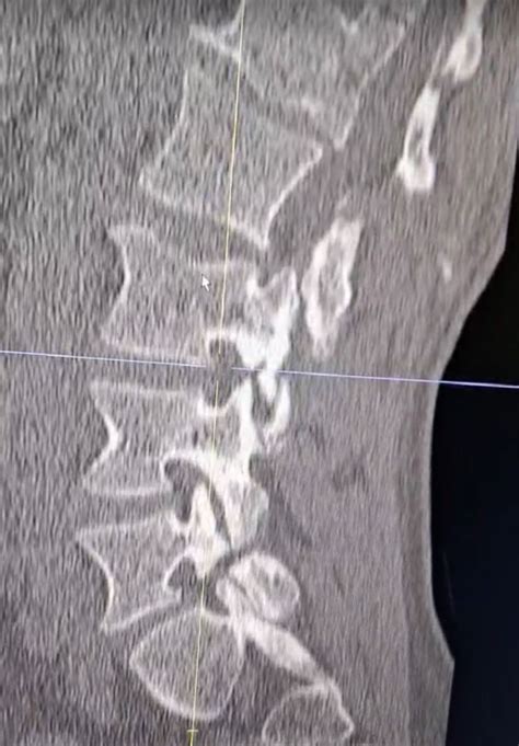 Milenko Savic On Linkedin Surgical Repair Of L5 Pars Interarticularis Chronic Fracture As A