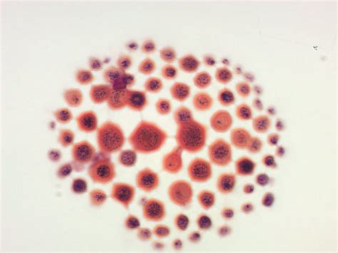 Cryptococcus Neoformans In Csf R Microbiology