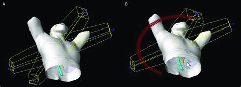 Typical Beam Arrangements For Static Conormal Radiotherapy Crt A