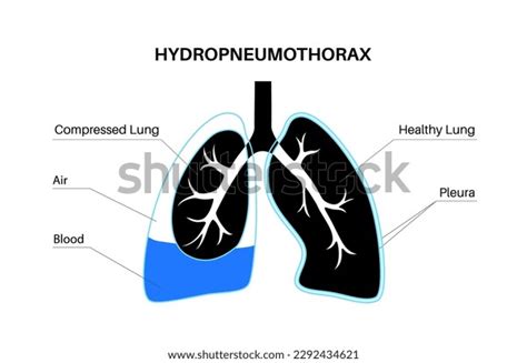 Hemopneumothorax Lungs Disease Combination Two Medical Stock Vector