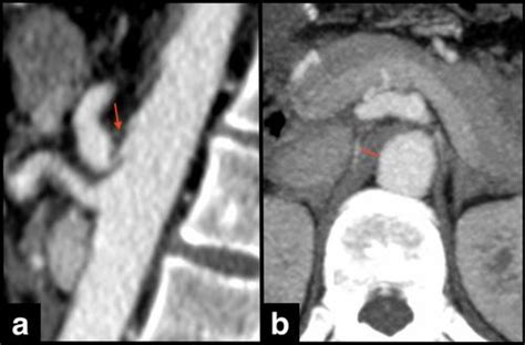 接受血管内栓塞治疗的内脏动脉瘤 假性动脉瘤患者正中弓状韧带压迫腹腔动脉的发生率 Abdominal Radiology X Mol