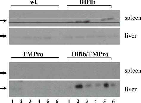 Figure 2 From Cause Effect Relation Between Hyperfibrinogenemia And