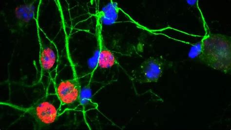 Subtypes And Sex Differences Discovered In ALS Technology Networks