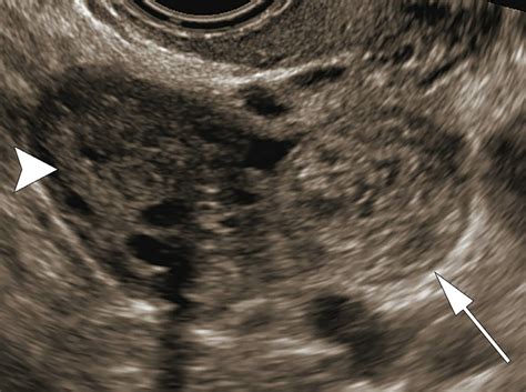 The Blob Sign A 32 Year Old Pregnant Patient 6 Weeks Gestational