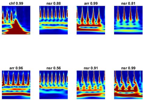 Figure 16 From Classification Of Ecg Signals Using Deep Neural Networks Semantic Scholar