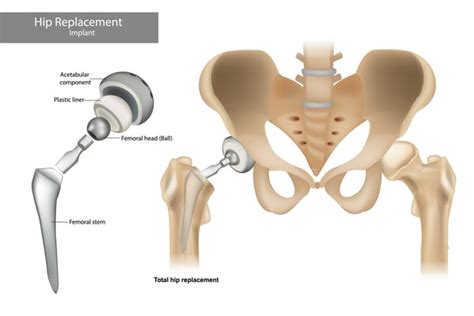 Labrum Repair Vs Total Hip Replacement Procedures Recovery And