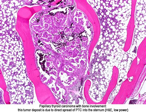 Pathologic Calcification