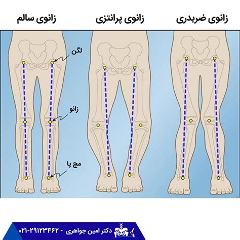 پای پرانتزی چیست؟ علائم، تشخیص و نحوه درمان دکتر امین جواهری