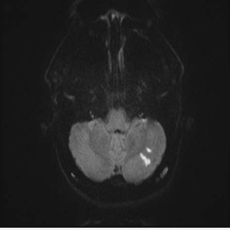 Mri Of The Brain With Diffusion Weighted Images Dwi Shows Small Download Scientific Diagram