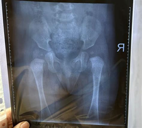 Ответы Видна ли на фотографии ренгена дисплазия тазобедренных
