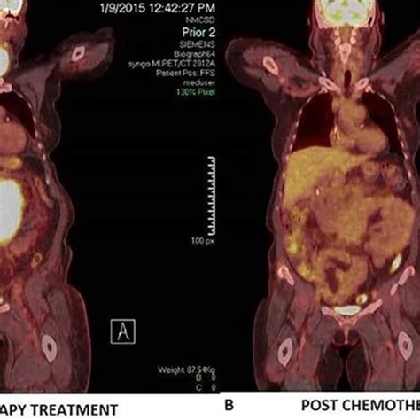 A Thyroid Ultrasound Showing A Dominant Hypervascular Left Thyroid Mass