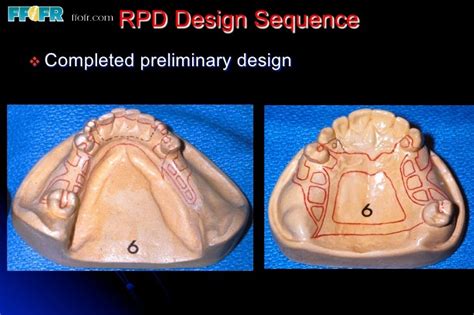 7designing Rpds Planning Sequence For Rpd Patients