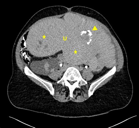 Diffuse Uterine Leiomyomatosis A Rare Discovery Eurorad