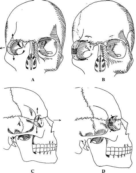 Reconstruction Of The Anophthalmic Orbit By Orbital Osteotomy And Free