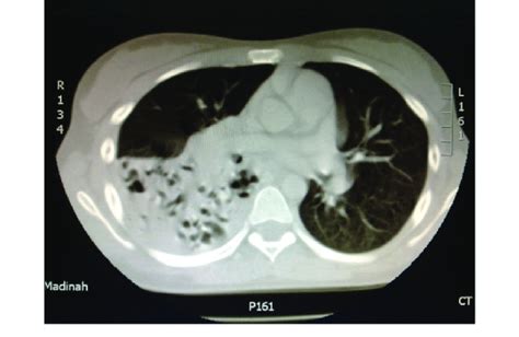 Bronchial Mass Extending From Right Lower Lobe Bronchus Obstructing It