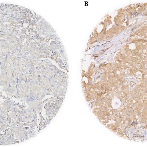 Ube2c Tmas Core Protein Expression A Ube2c Weak Ihc Expression B