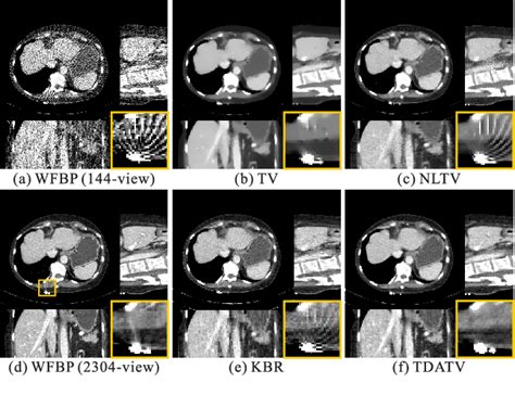 Figure 9 From Helical Ct Reconstruction From Sparse View Data Through