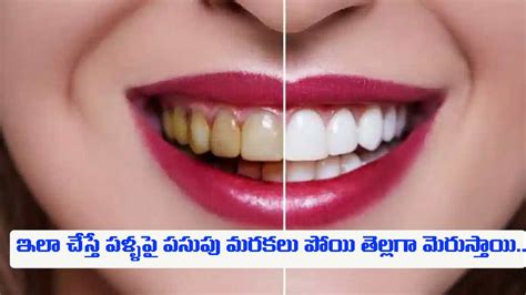 Teeth Whitening ఇలా చేస్తే పళ్ళపై పసుపు మరకలు పోయి తెల్లగా మెరుస్తాయి