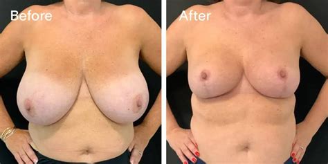 Extra Large Breast Augmentation Before And After