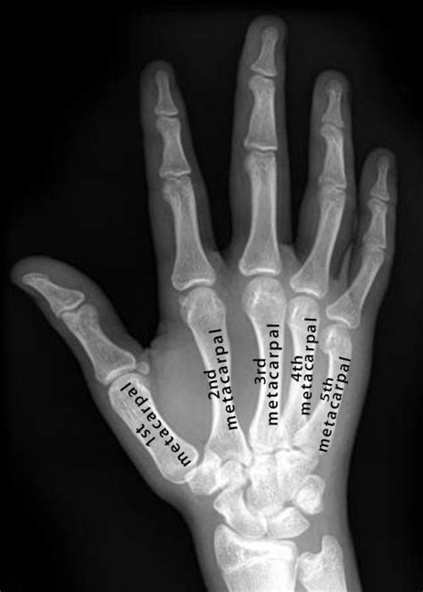 Metacarpals Definition Location Anatomy Function Diagram