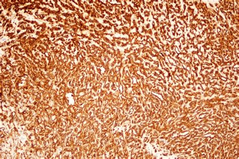 病例分享肝血管肉瘤1例 资讯频道 华夏病理网